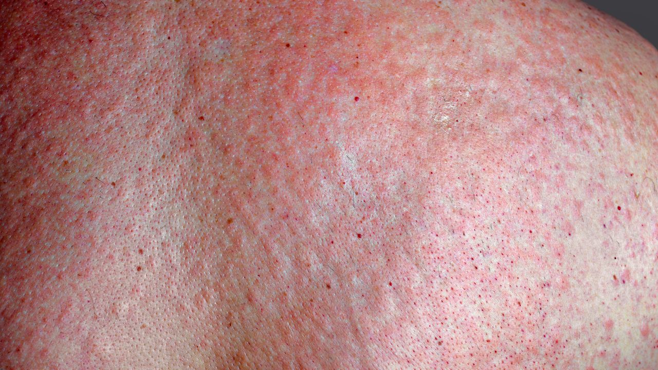 Heat Rash Disease and Best Treatment - HerbTib Blog